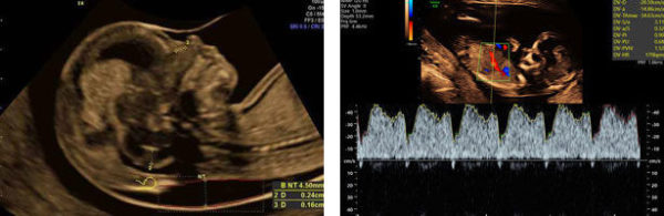 Fetal Ultrasound – Palash – A Centre For Fetal Medicine